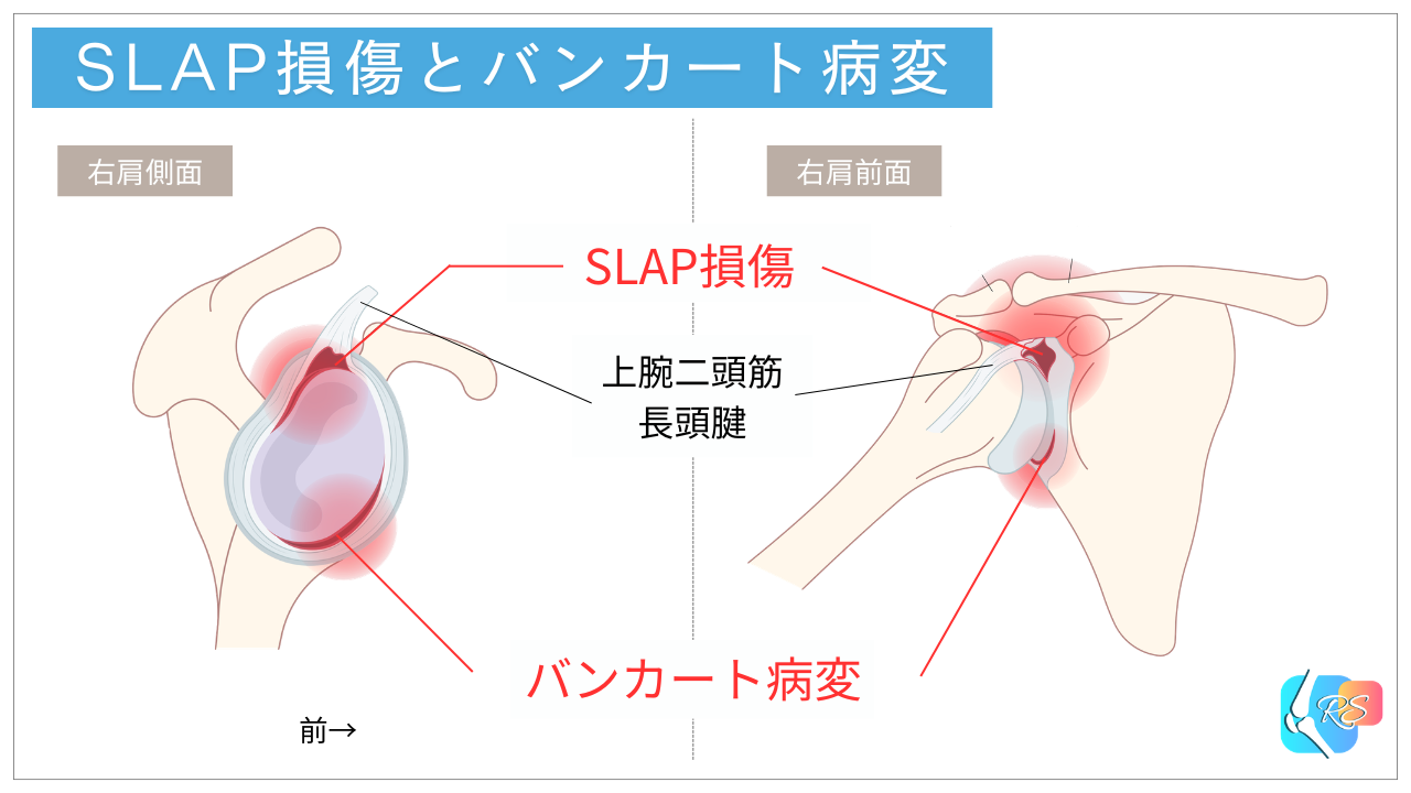 肩関節唇損傷（SLAP損傷・Bankart病変）とは？症状・検査・治療とリハビリを解説