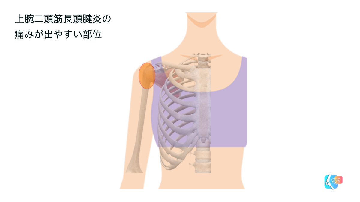 上腕二頭筋長頭腱炎とリハビリテーション