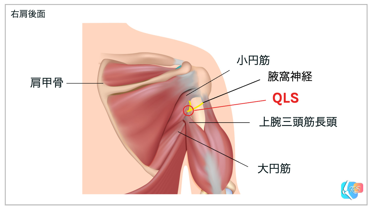 肩QLS症候群とリハビリテーション