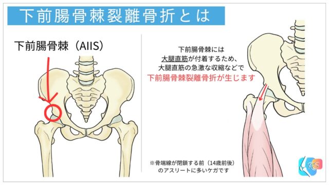 成長期アスリートに多い下前腸骨棘裂離骨折とは？原因・診断・リハビリまとめ