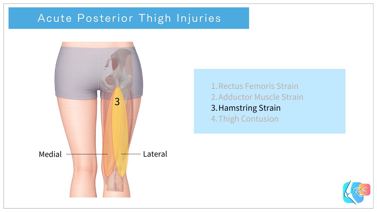Thigh and Lower Leg Pain in Athletes: Common Sports Injuries, Overuse ...