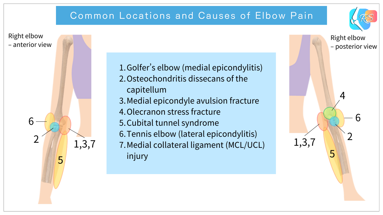 Elbow Pain: Common Injuries and Overuse Conditions (Sports & Everyday Life)
